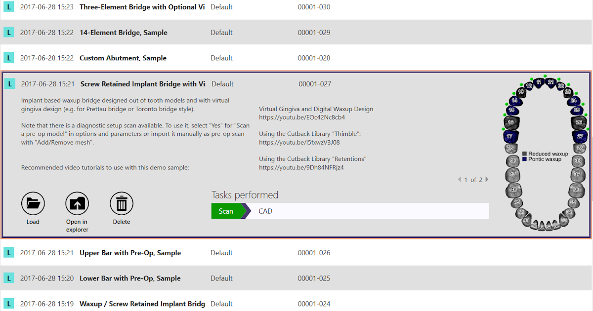 Dental CAD/CAM system: Implant Bridge design by exocad
