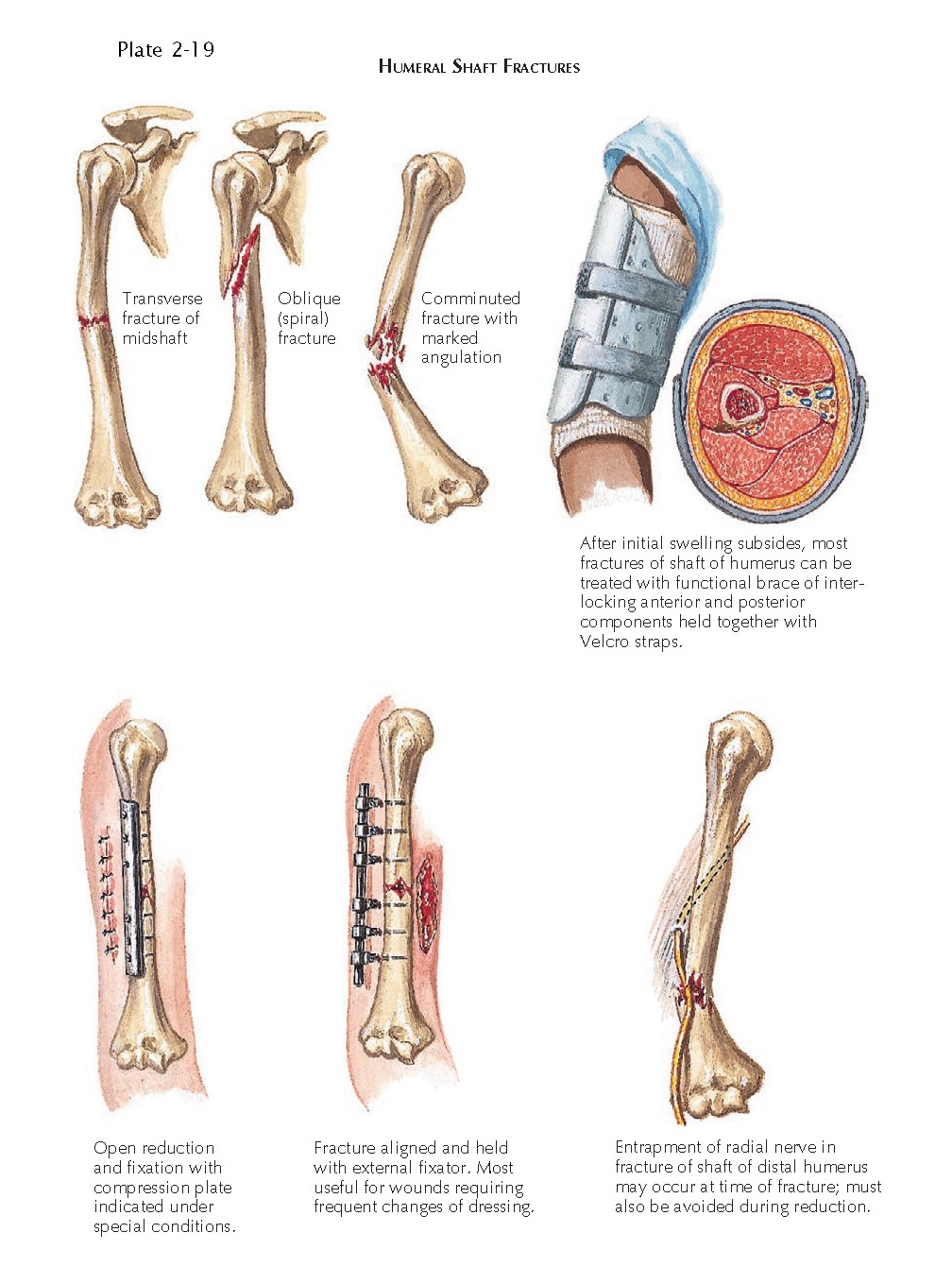 HUMERAL SHAFT FRACTURES - pediagenosis