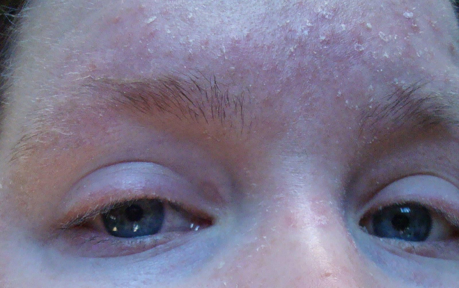 Scarlet Letters, dealing with vascular rosacea and the rest ...