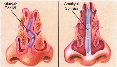 Correcting The Deviated Septum