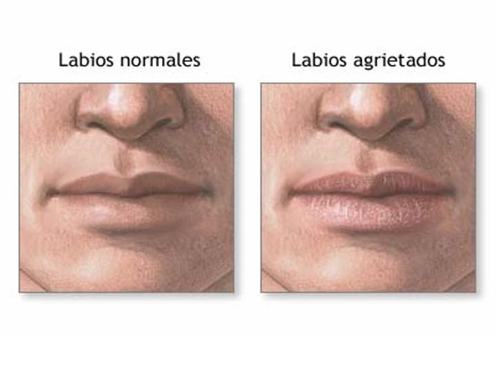 NUTRICIÓN HIGIENISTA: LABIOS AGRIETADOS Y CORTADOS