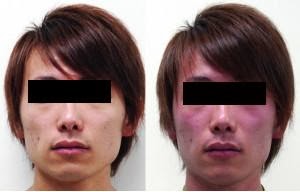 Alcohol flush reaction Remedies