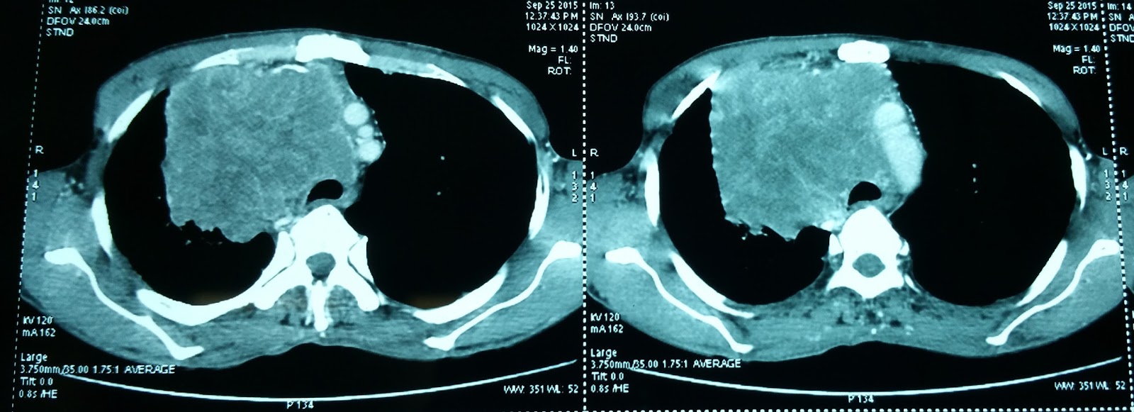 Chest Medicine Made Easy-Dr Deepu: Image Archives SVC obstruction- CT ...