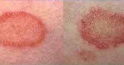 causes of eczema(ring worm)