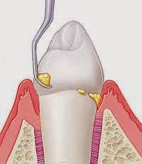 Raspado Radicular: Raspado Radicular