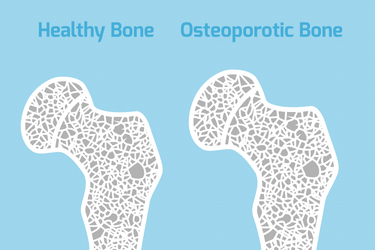 Osteoporosis Treatment & Care