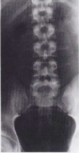 COLUMNA LUMBAR AP