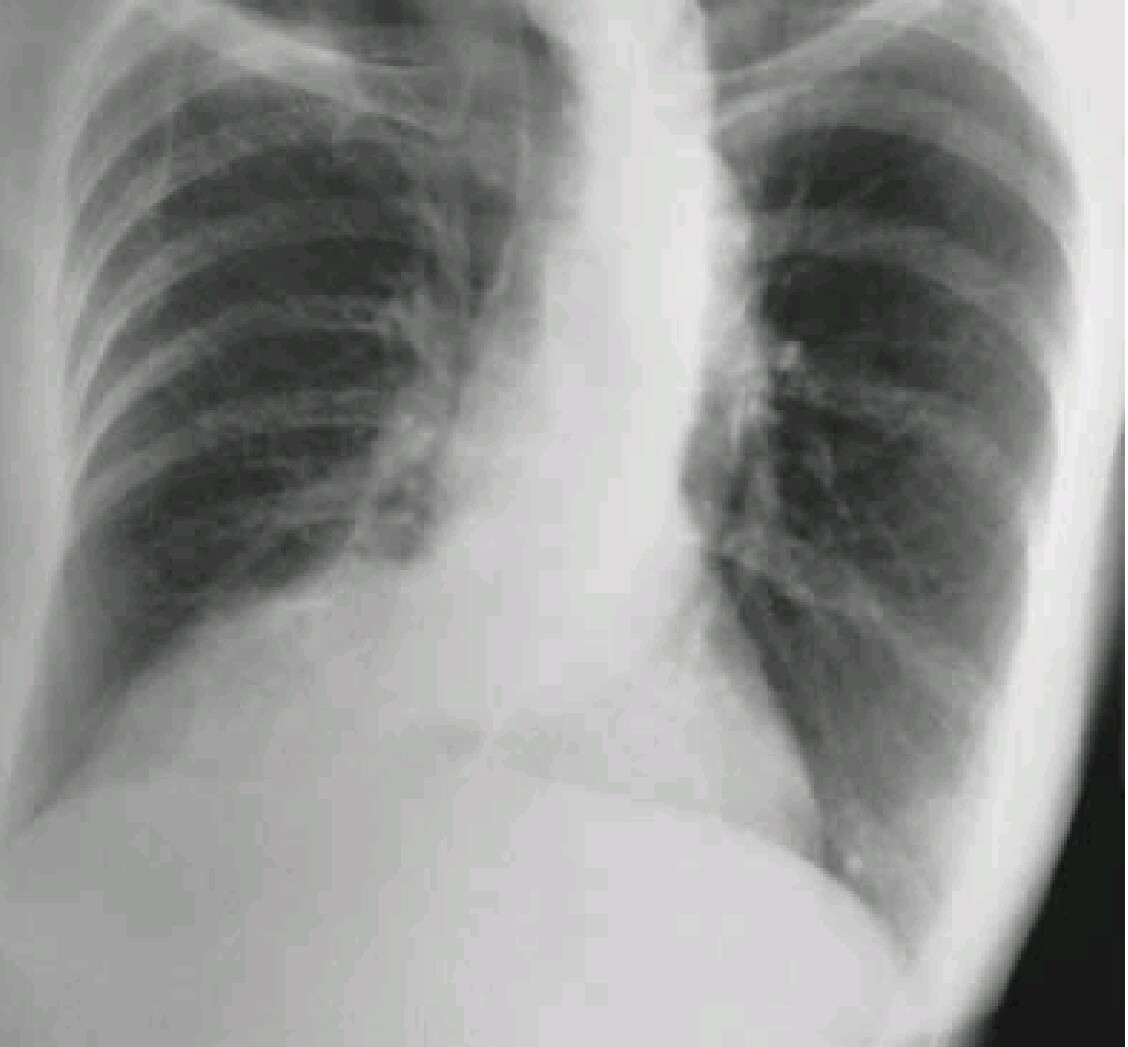 DrRadio: CHEST WALL SKELETAL DEFORMITIES