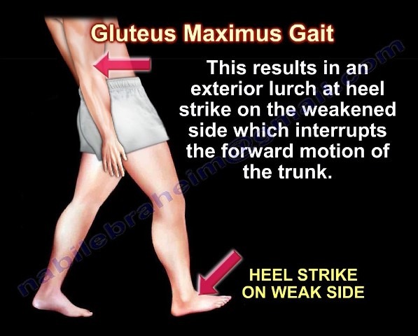 gluteus maximus gait I lurching gait - PHYSIO STUDY