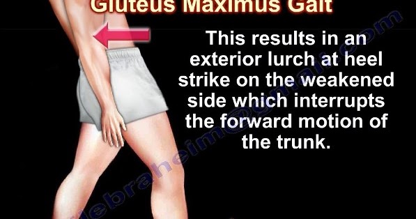 gluteus maximus gait I lurching gait - PHYSIO STUDY