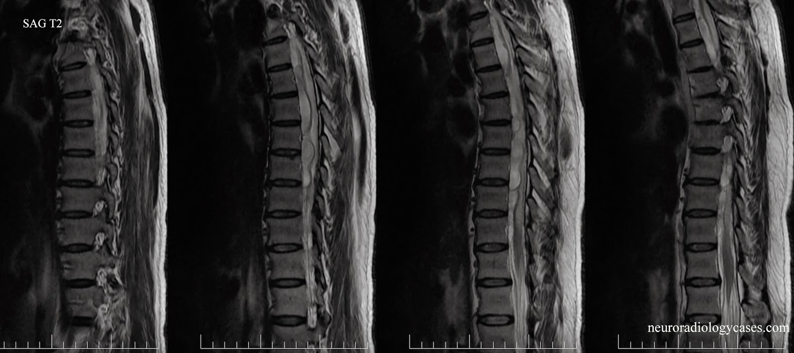 Dr Balaji Anvekar Frcr Focal Adhesive Arachnoiditis Of Spinal Cord