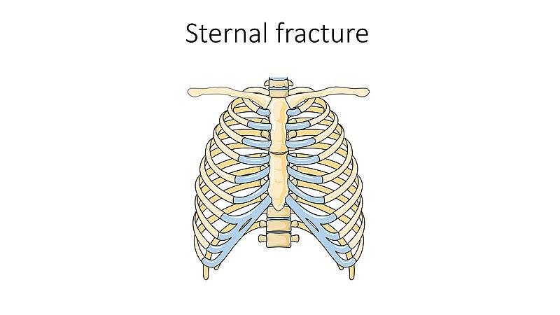 Sternum Fracture Treatment | Sternum Bone Fracture Surgery