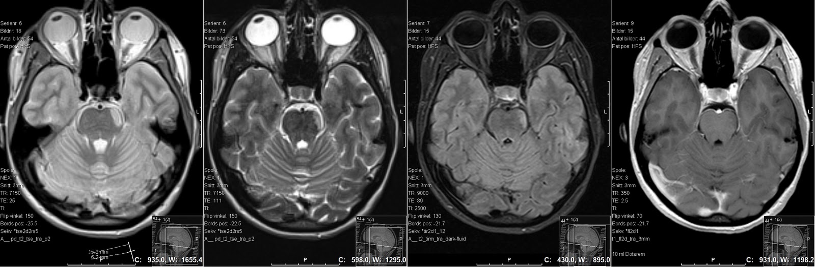 Proton Density in Multiple Sclerosis