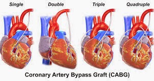 Medical Treatment Pictures-for Better Understanding: Triple Bypass ...