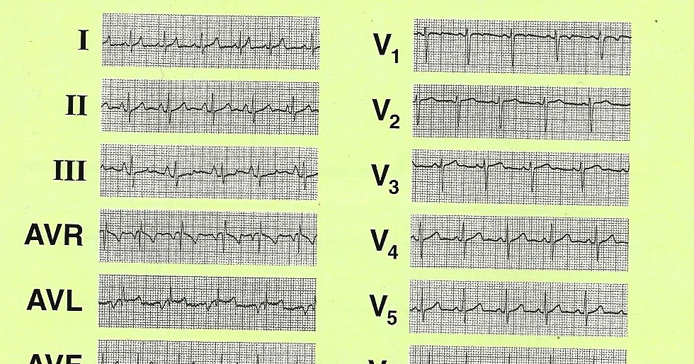 Electrocardiograma: ECG normal