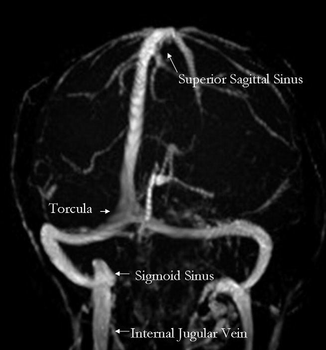 MRI Protocols: TORCULA IN MRI BRAIN ANATOMY , MRV