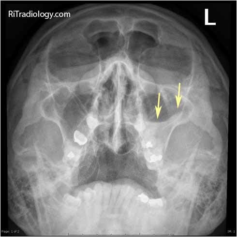 RiT radiology: Acute Sinusitis