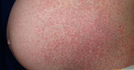 Sekilas Tentang Pruritic Urticarial Papules and Plagues of Pregnancy ...