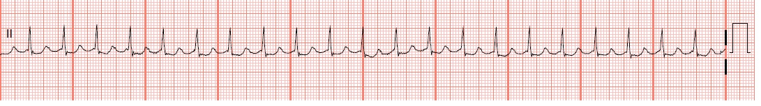 EKG Rhythm Strips 29: Junctional Rhythms