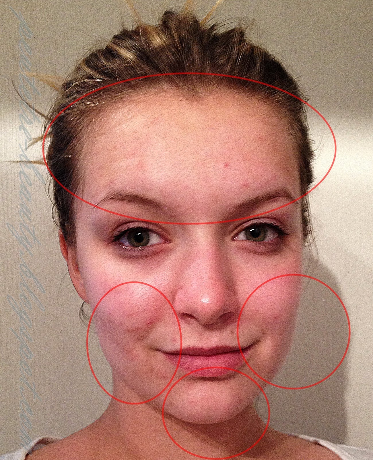 kevinstonene: Pickel Im Gesicht Trockene Haut