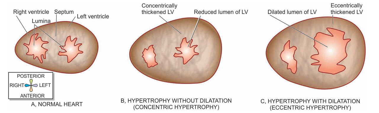 Hypertrophy Of The Heart