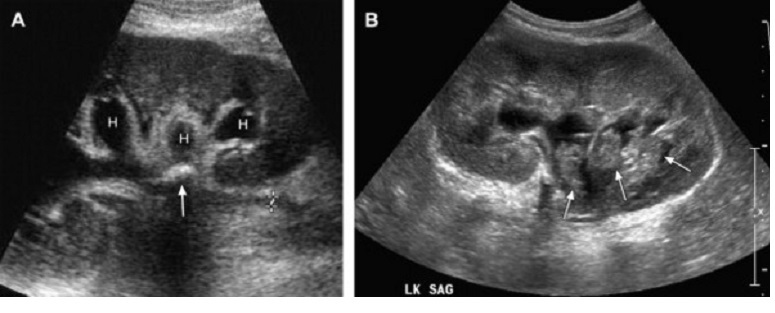 Renal Ultrasound Cases (Adrenal haemorrhage, Perinephric haematoma ...