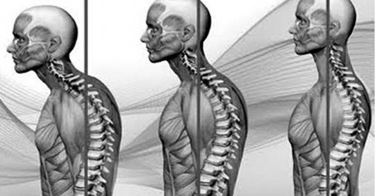 CLINICA ZAFRILLA SERVICIOS MEDICOS Y FISIOTERAPIA: CIFOSIS: CAUSAS ...