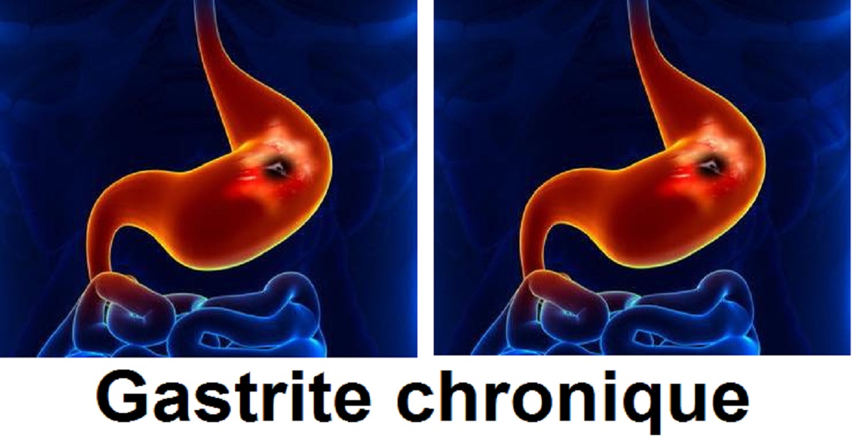Quels aliments supprimer en cas de gastrite ? ~ Sport et Santé