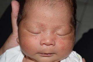 VIRTUAL GRAND ROUNDS IN DERMATOLOGY 2.0: Neonatal Acne