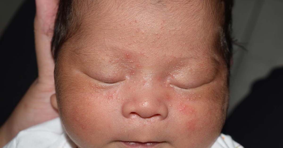 VIRTUAL GRAND ROUNDS IN DERMATOLOGY 2.0: Neonatal Acne