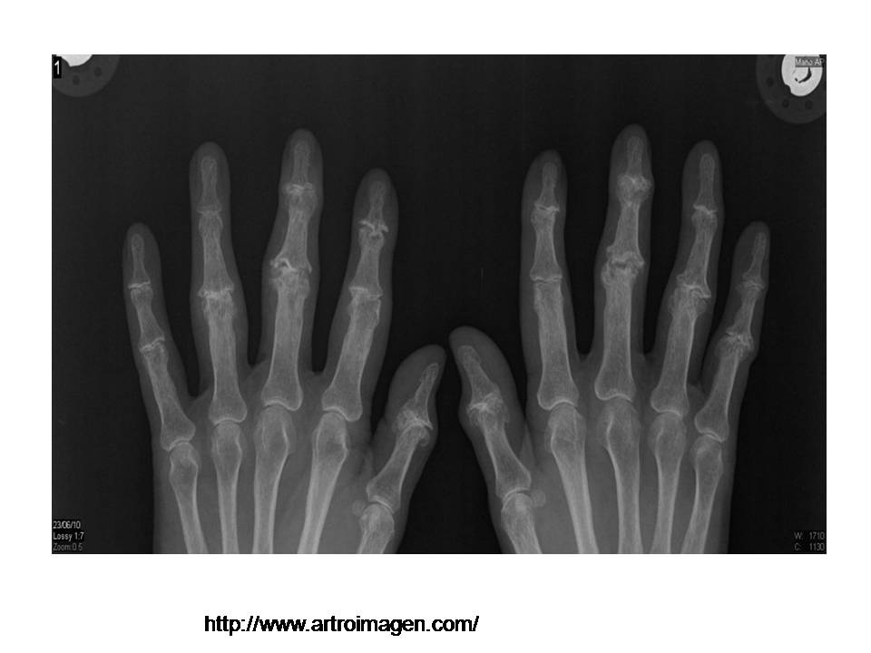 Diagnóstico de la artrosis