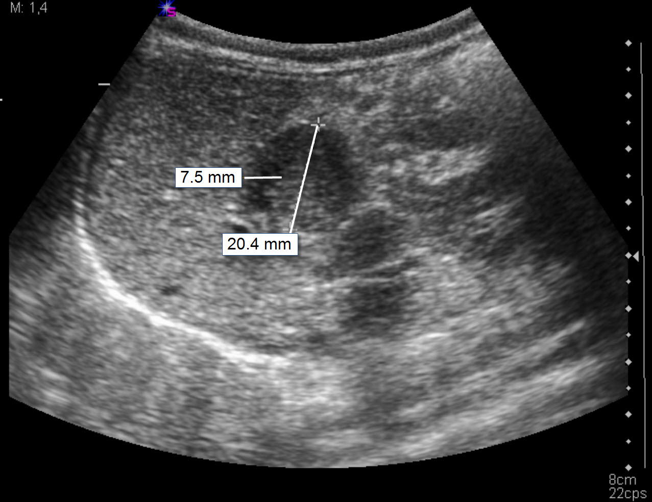 RADIOLOGIA LLEIDA: ESTENOSIS HIPERTROFICA DE PILORO
