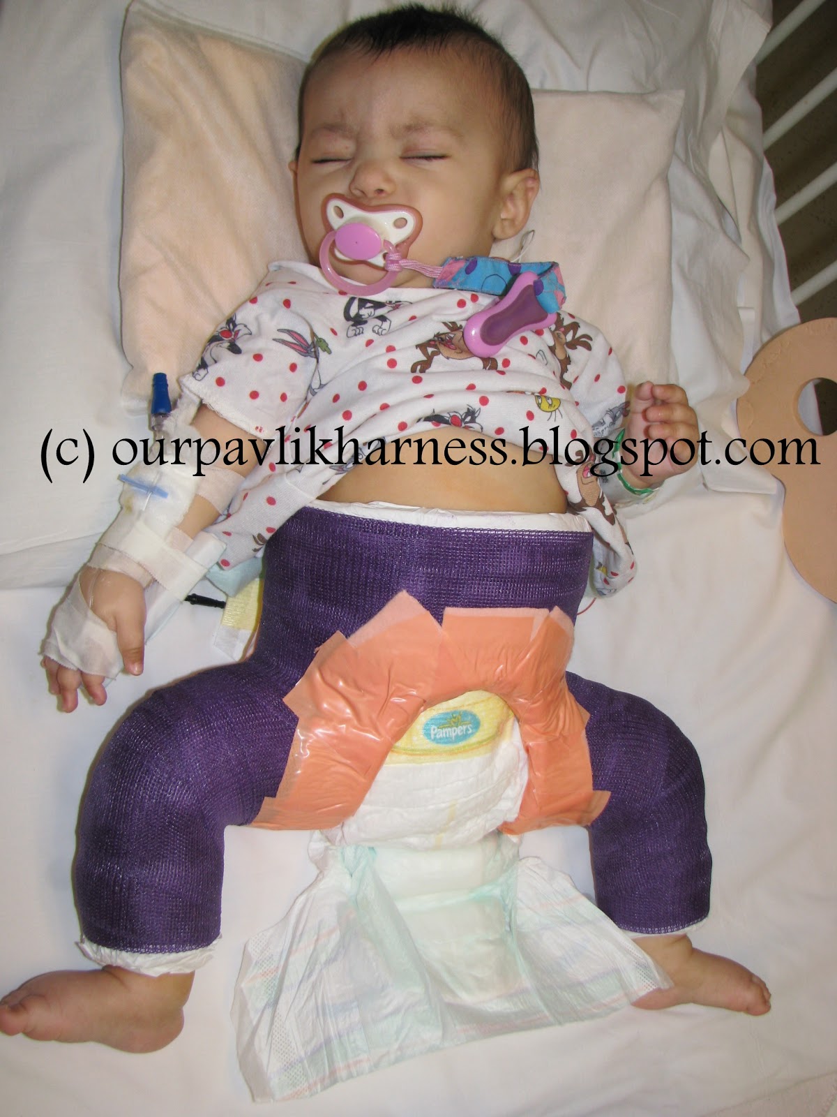 Our Pavlik Harness and journey with Hip Dysplasia: we are home!