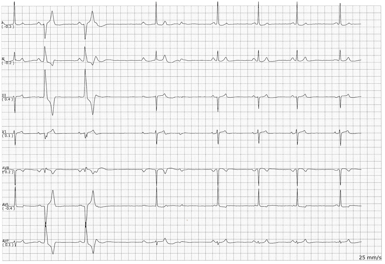 Float Nurse: Fusion beats and Nonconducted PACs