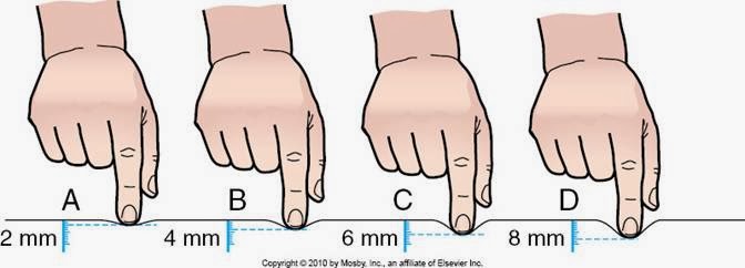 Blog Wijj: PEMERIKSAAN PITTING EDEMA