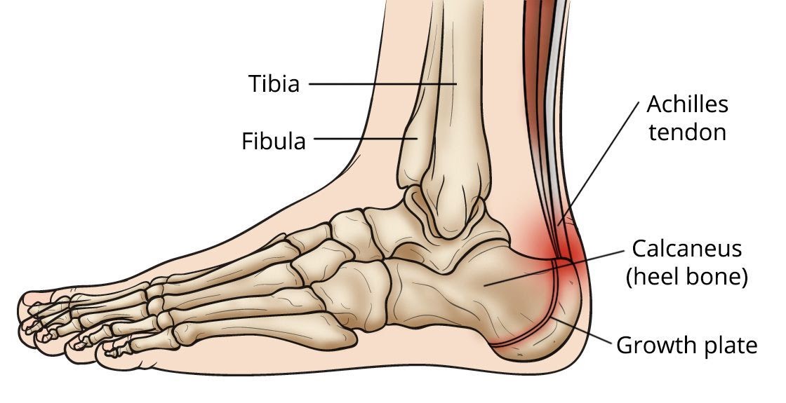 MedFriendly Medical Blog Heel Pain Causes And Relief Myths And MedFriendly Medical Blog Heel Pain Causes And Relief Myths And