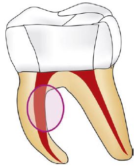 What is Ledge, Zipping, Strip Perforation and Apical Transportation in ...