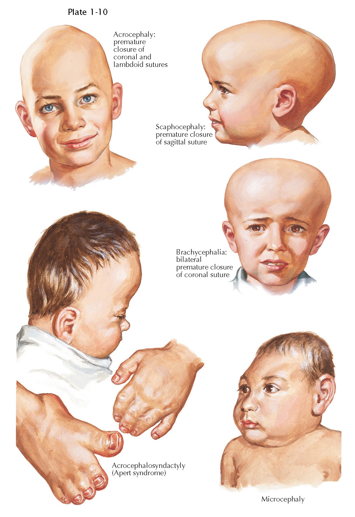 CRANIOSYNOSTOSIS - pediagenosis