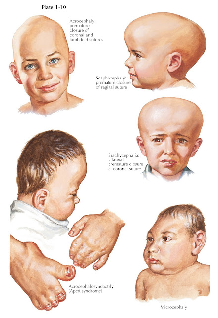 CRANIOSYNOSTOSIS - pediagenosis