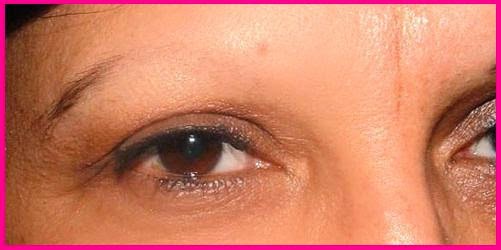 Eyebrow loss - the best solution