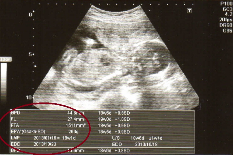 Atika M.A Wibowo's Blog: Konten Hasil USG Kehamilan