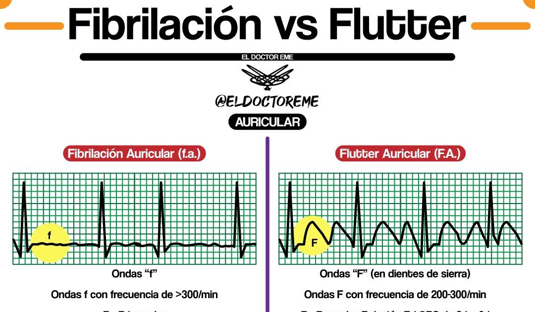 ZONA DE SALUD DE OFRA: FIBRILACIÓN VS FLUTTER AURICULAR.