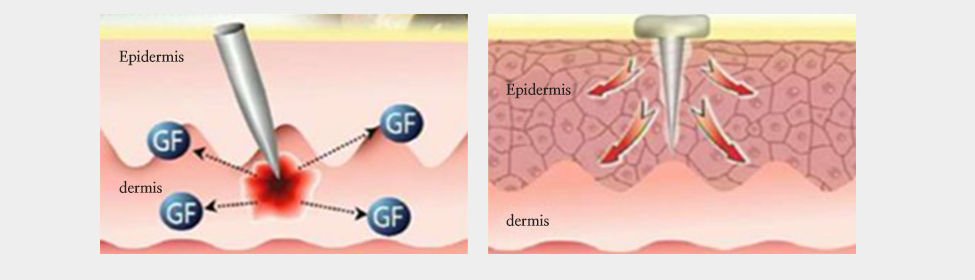 Renewme Skin Clinic: The significant feature of the Secret laser - The ...