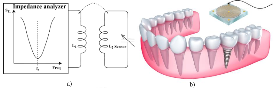 Sedemos News: [paper] Capacitive Sensor for Dental Implants