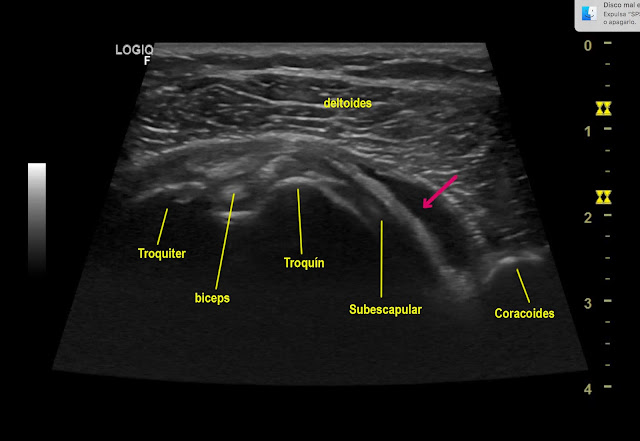 Ecografía en Atención Primaria: BURSITIS en hombro