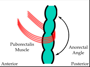 Caso clinico: Niño 3 años con Prolapso Rectal