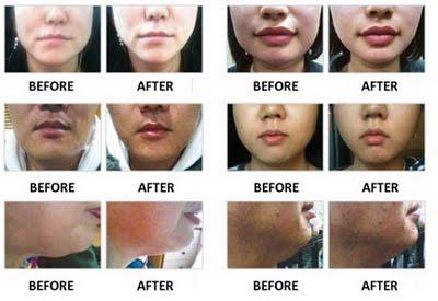 Lush Extra V-Line Lift Up, Good Bye Double Chin | All about Slimming