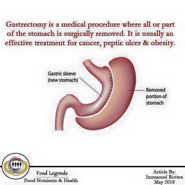 Common Questions on Gastrectomy - The Food Legends