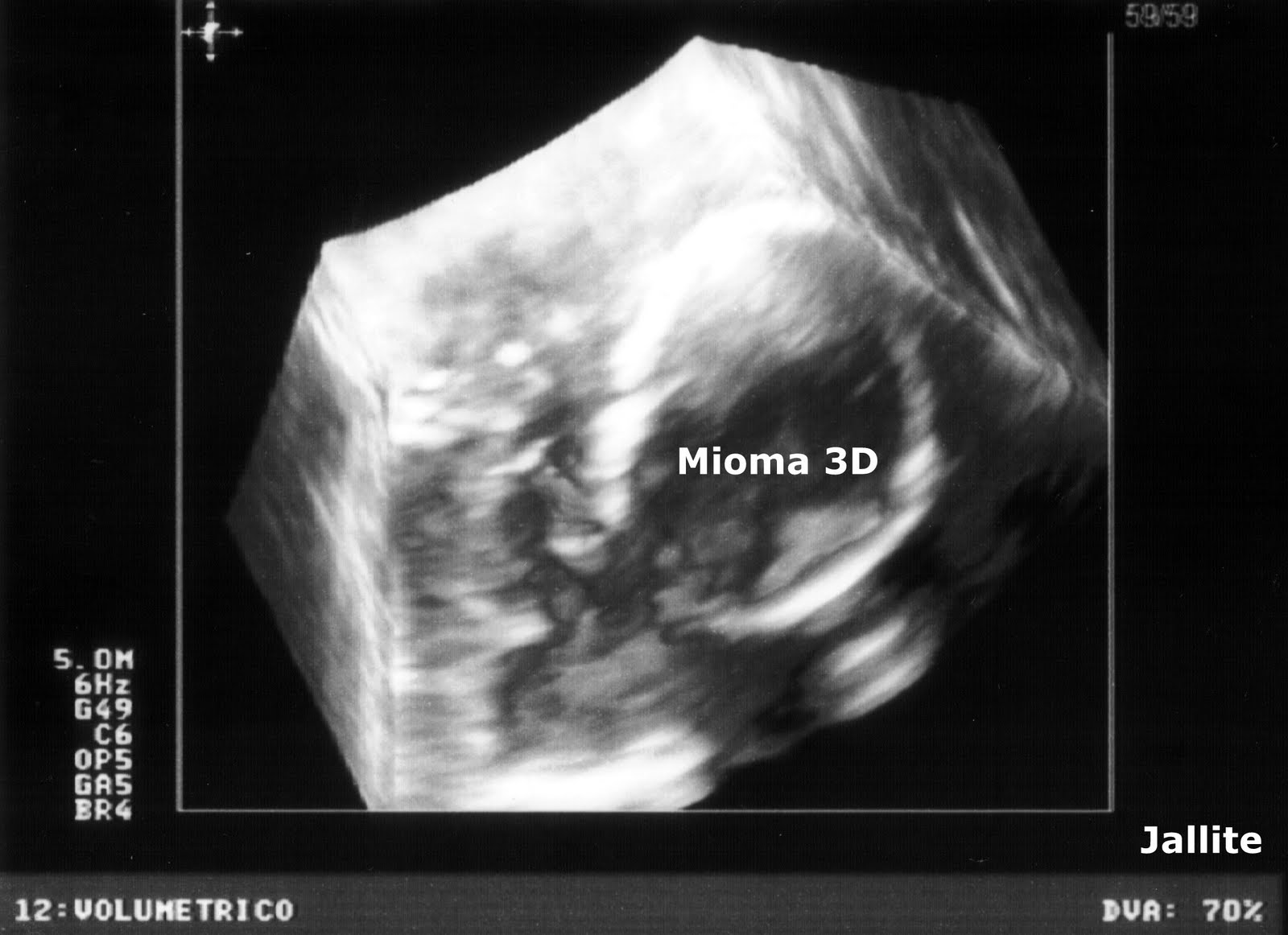 Mioma Calcificado y DIU