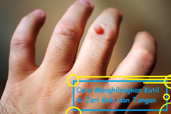 Cara Menghilangkan Kutil di Jari Kaki dan Tangan - Siddix